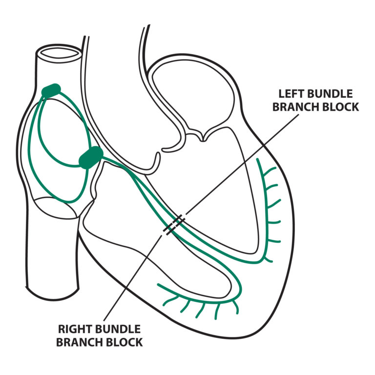 Bundle Branch Blocks (Part 1 – Left and Right Bundle Branch Blocks ...