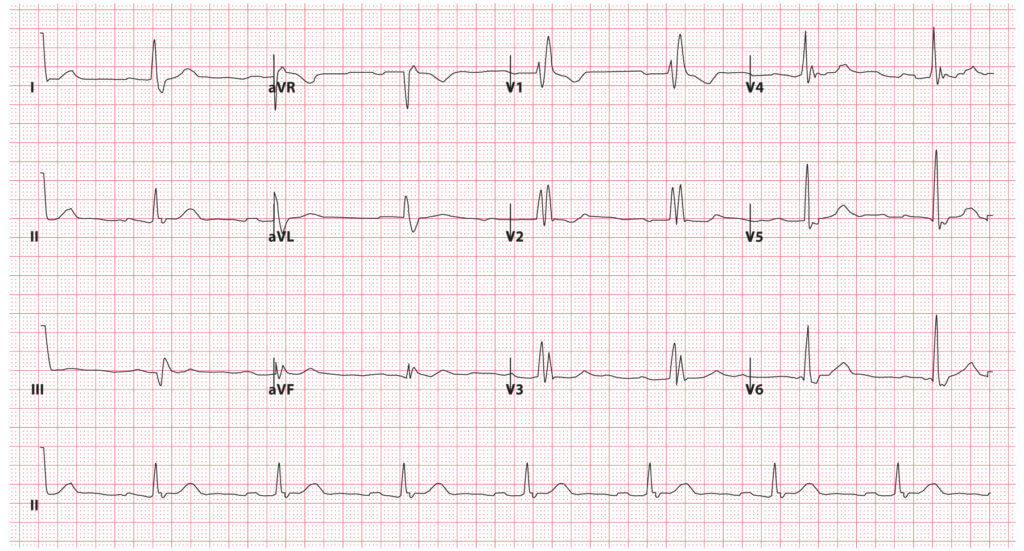 Bundle Branch Blocks (Part 1 – Left and Right Bundle Branch Blocks ...