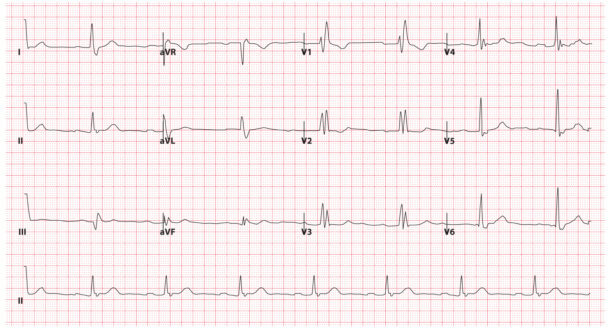 Bundle Branch Blocks (Part 1 – Left and Right Bundle Branch Blocks ...