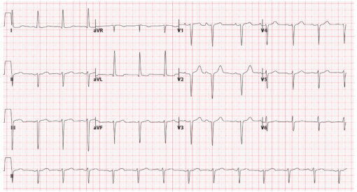 Bundle Branch Blocks (Part 2 – Fascicular Blocks) - Medical Exam Prep