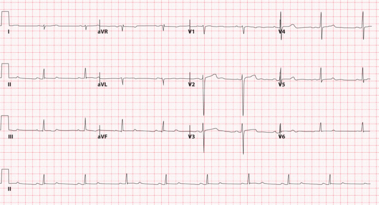 Bundle Branch Blocks (Part 2 – Fascicular Blocks) - Medical Exam Prep