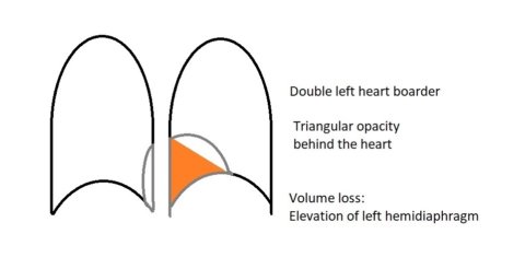 Left lower lobe collapse - Medical Exam Prep