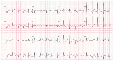 How To Read a Paediatric ECG - Medical Exam Prep