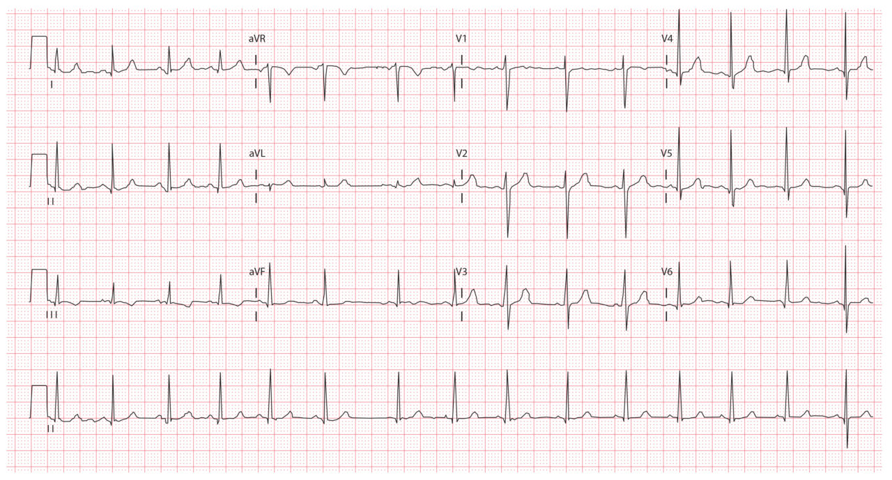 How To Read a Paediatric ECG - Medical Exam Prep