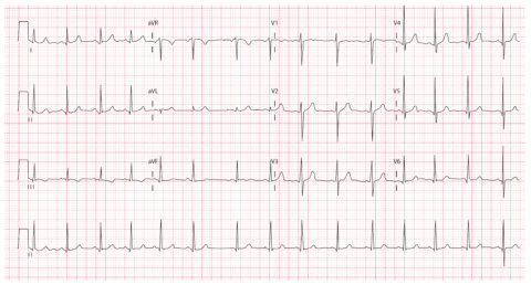 How To Read a Paediatric ECG - Medical Exam Prep