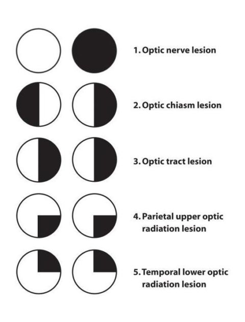 The Visual Pathway and Visual Field Defects - Medical Exam Prep