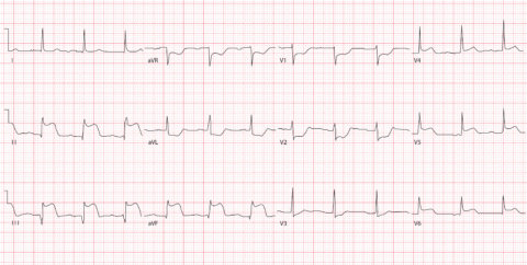 Recognising Myocardial Infarction Patterns on the ECG - Medical Exam Prep