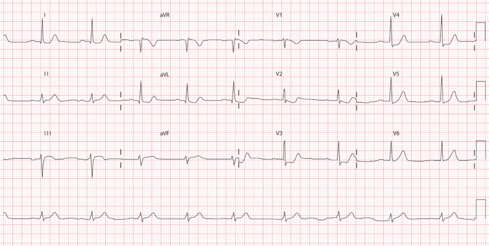 Recognising Myocardial Infarction Patterns on the ECG - Medical Exam Prep