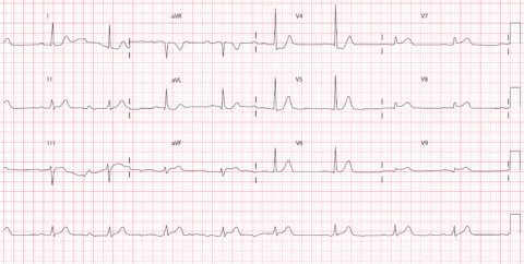 Recognising Myocardial Infarction Patterns on the ECG - Medical Exam Prep