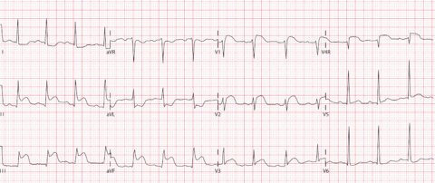 Recognising Myocardial Infarction Patterns on the ECG - Medical Exam Prep