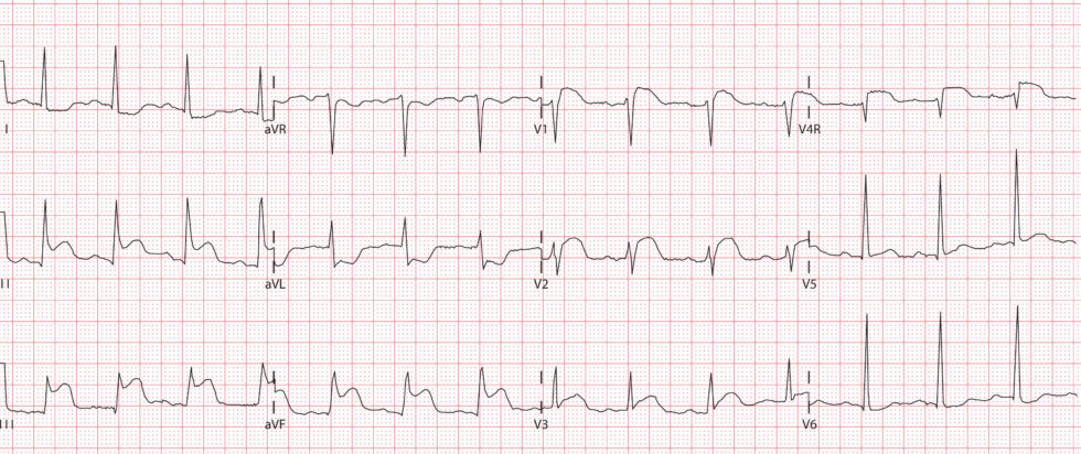 Recognising Myocardial Infarction Patterns on the ECG - Medical Exam Prep