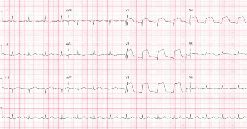 Recognising Myocardial Infarction Patterns on the ECG - Medical Exam Prep